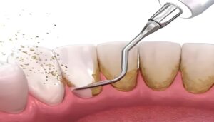Tartre dentaire : causes, prévention et traitement